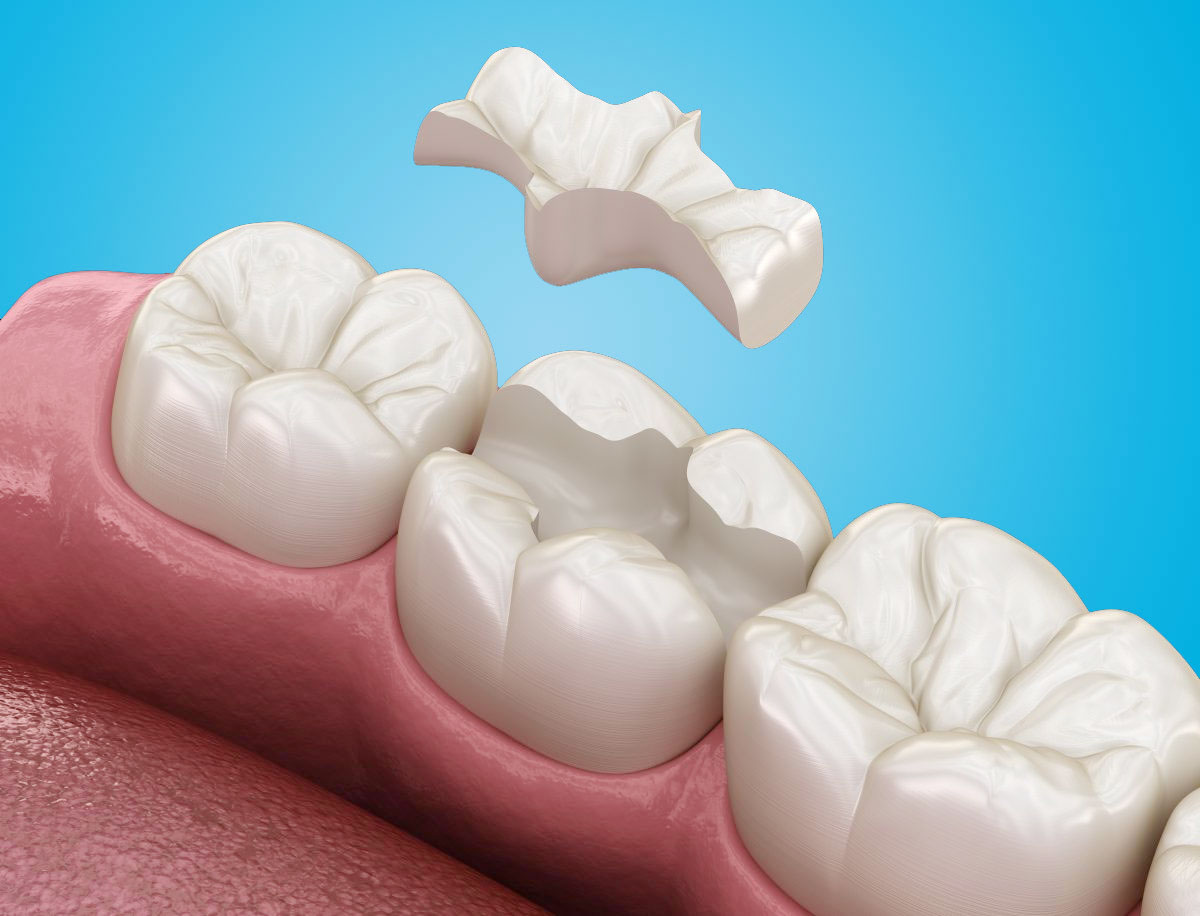 Inlays, Onlays and Overlays – The Lab Guys USA