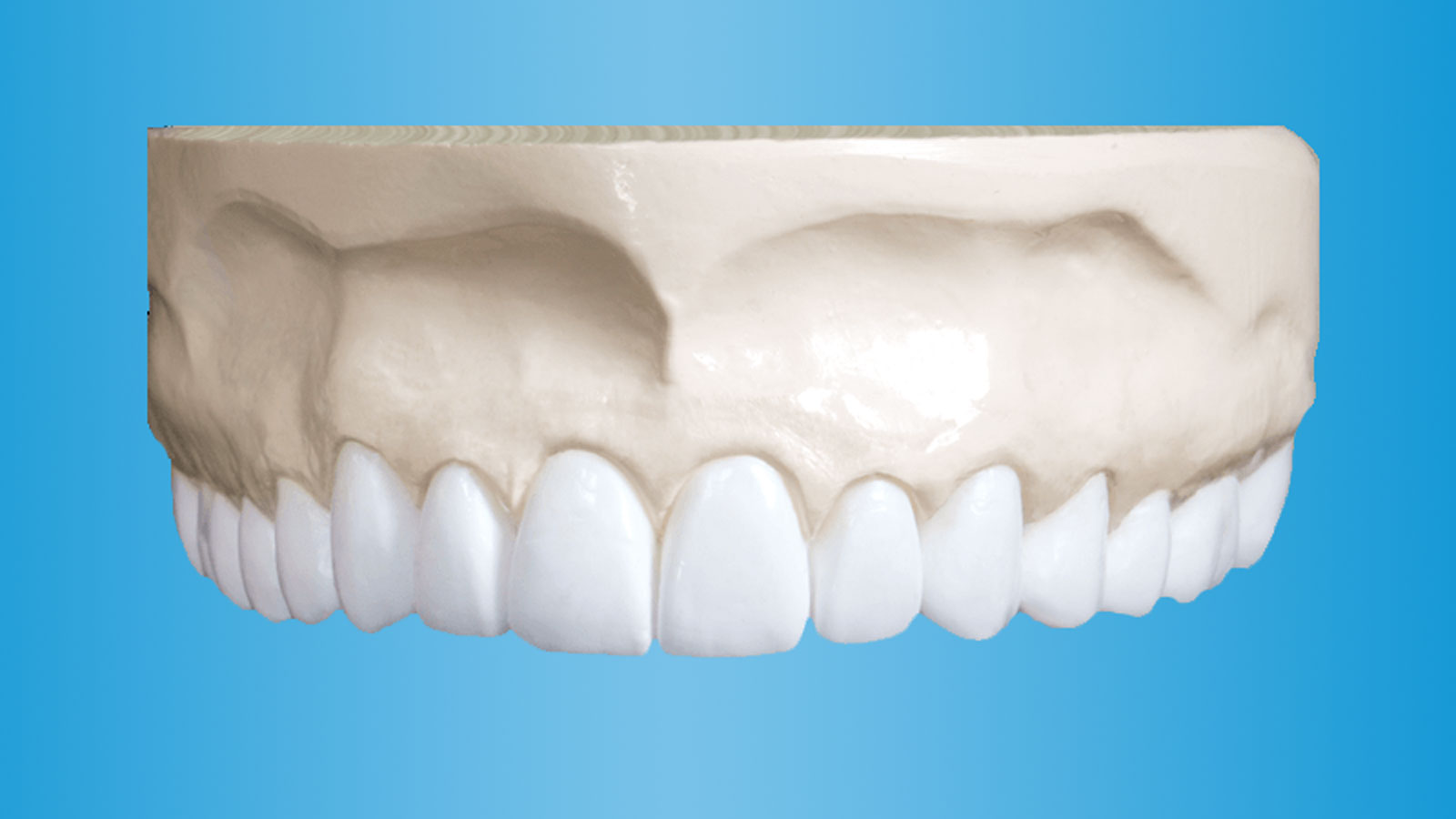 Wax Ups – The Lab Guys USA